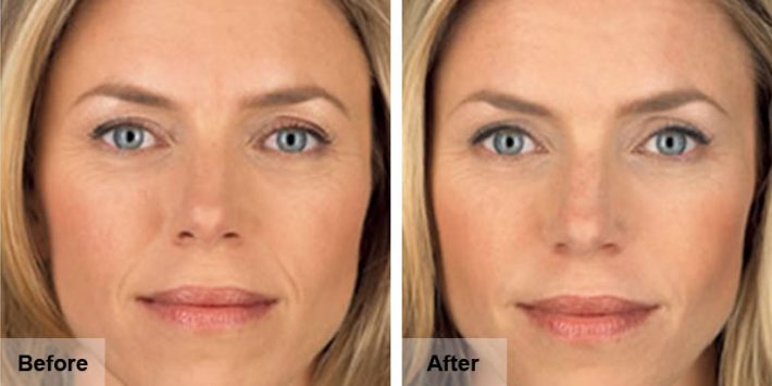 Dermal Fillers Hampshire | Andrea Jones Aesthetics